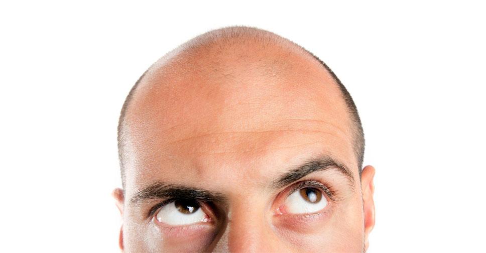 Средство от облысения у мужчин: лучшие народные рецепты и эффективные ...